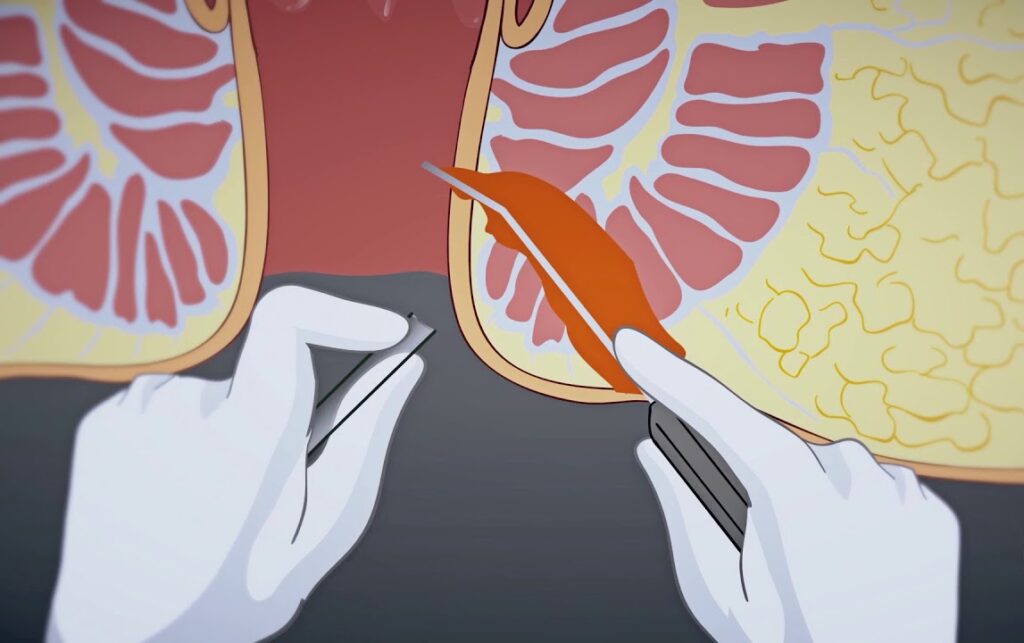 Radiant Recovery: Laser Surgery for Fistula at DN Hospital - DN Hospital